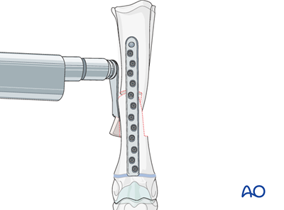 Corrective osteotomies for Angular limb deformities