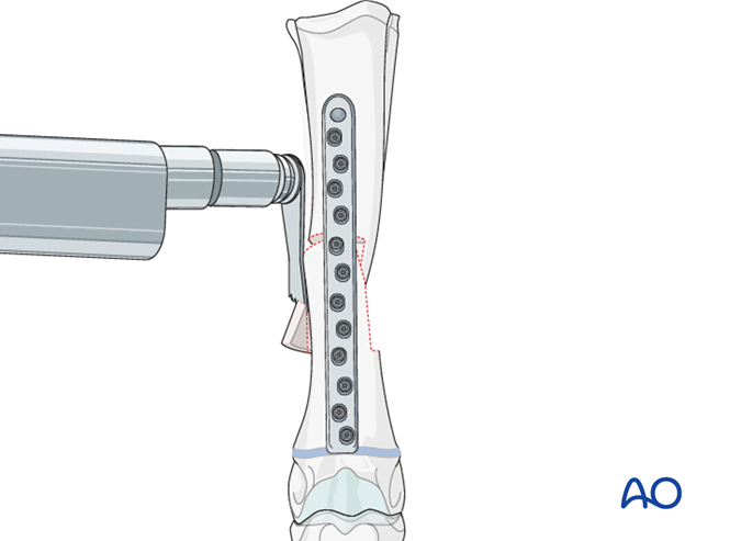 Corrective osteotomies for Angular limb deformities