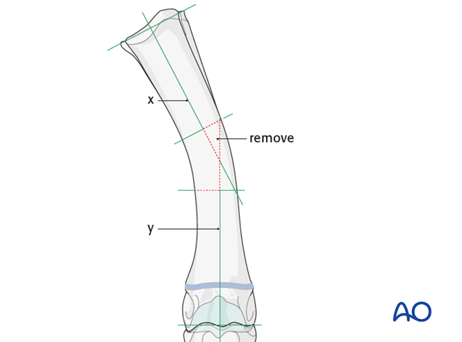 Corrective osteotomies for Angular limb deformities