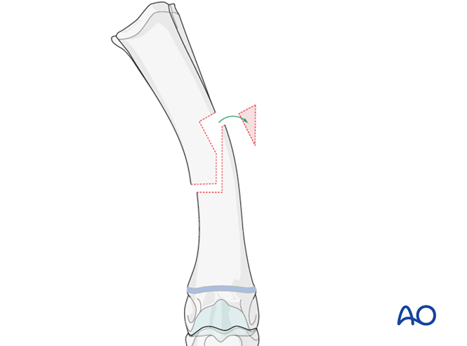 Corrective osteotomies for Angular limb deformities