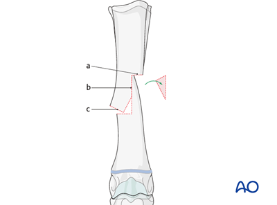 Corrective osteotomy for Angular limb deformities