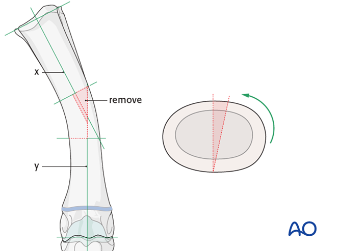 Corrective osteotomies for Angular limb deformities
