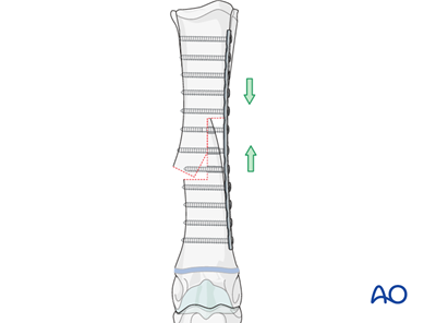 Corrective osteotomy for Angular limb deformities
