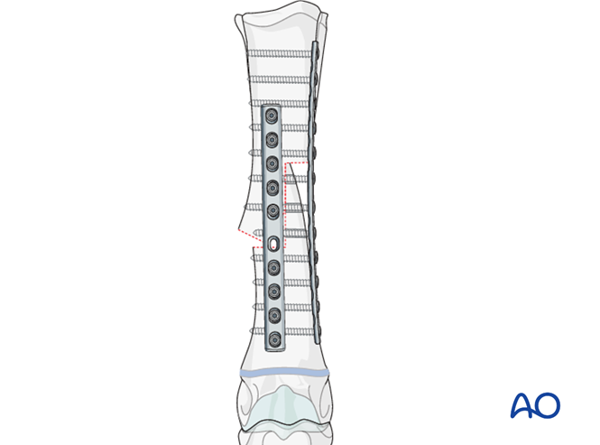 Corrective osteotomies for Angular limb deformities