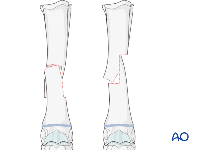 Corrective osteotomies for Angular limb deformities