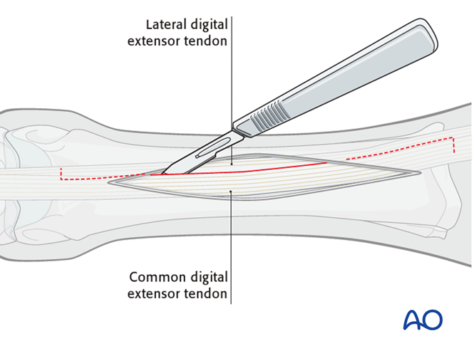 Approach for corrective osteotomy of the equine phalanges
