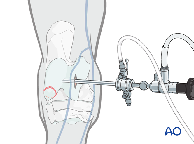 Resection for Talus: Trochlear ridge fractures