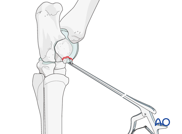 Resection for Talus: Trochlear ridge fractures