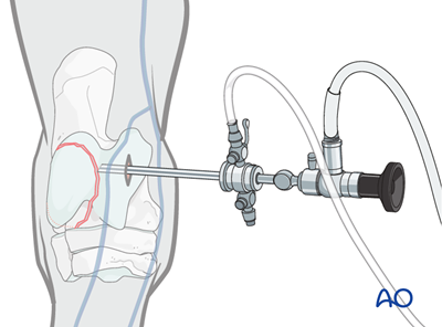 Screw fixation for Talus: Trochlear ridge fractures