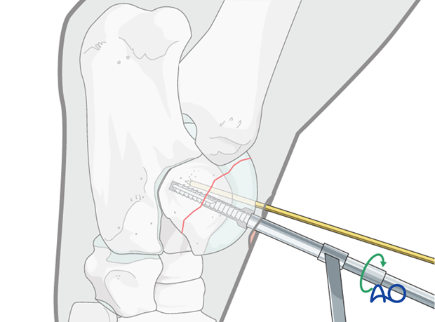 Screw fixation for Talus: Trochlear ridge fractures