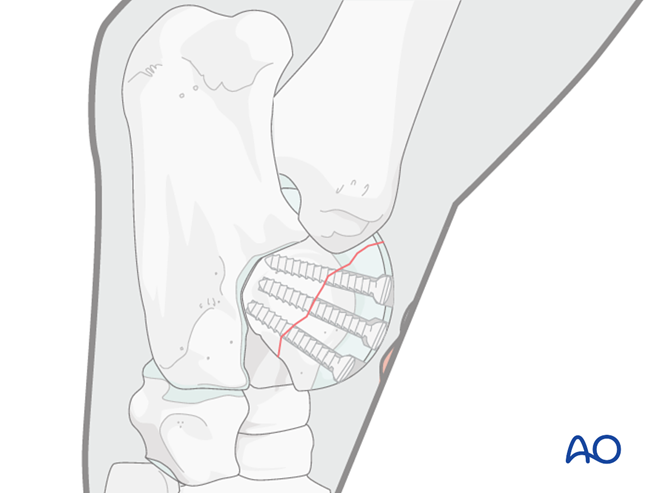 Screw fixation for Talus: Trochlear ridge fractures