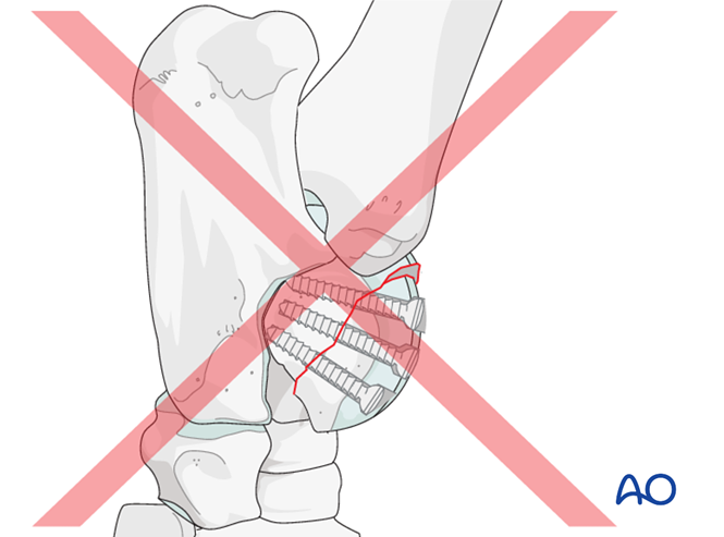 Screw fixation for Talus: Trochlear ridge fractures