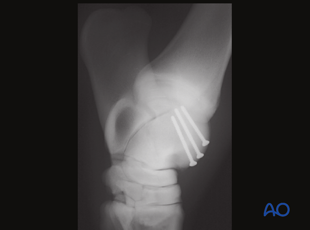 Screw fixation for Talus: Trochlear ridge fractures
