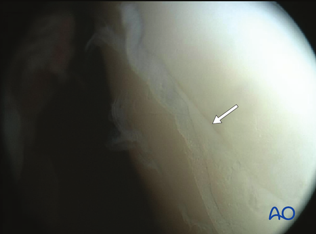 Screw fixation for Talus: Trochlear ridge fractures