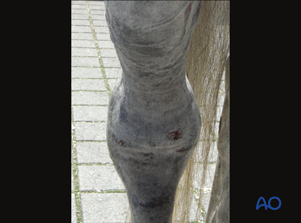 Screw fixation for Talus: Trochlear ridge fractures