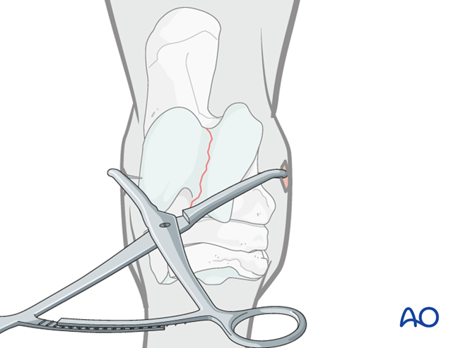 Screw fixation for Talus: Sagittal fractures