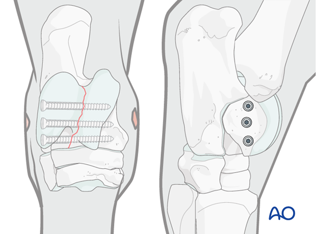 Screw fixation for Talus: Sagittal fractures