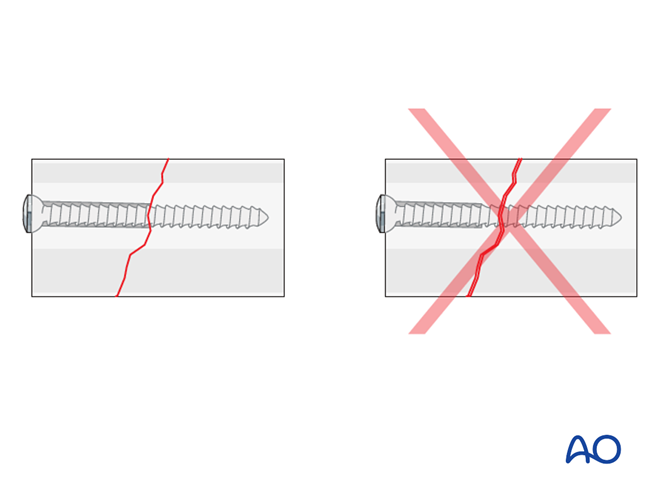 Screw fixation for Talus: fractures of the collateral ligament attachment