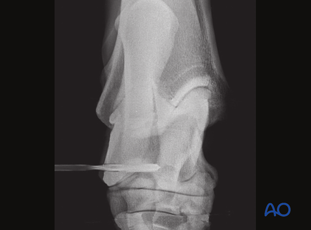 Screw fixation for Talus: Sagittal fractures