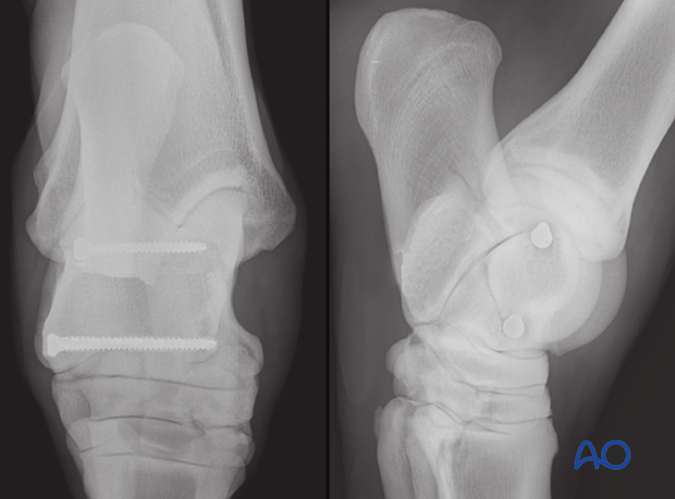 Screw fixation for Talus: Sagittal fractures