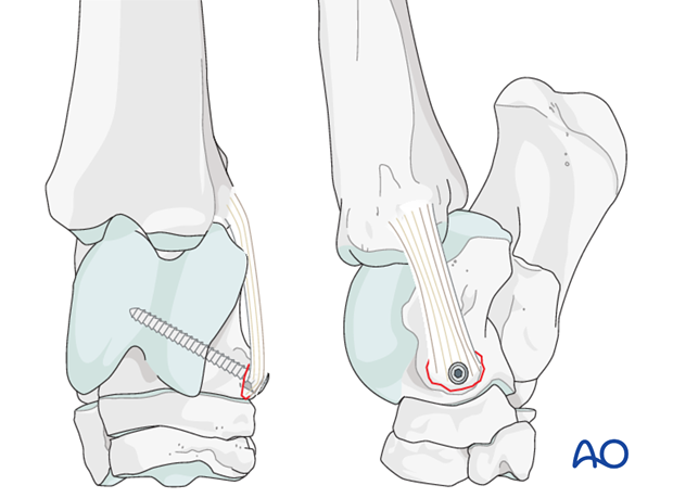 Screw fixation or resection for Calcaneus: Fractures of the collateral ...