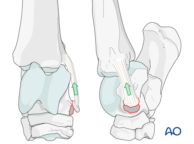Talus: fractures of the collateral ligament attachment