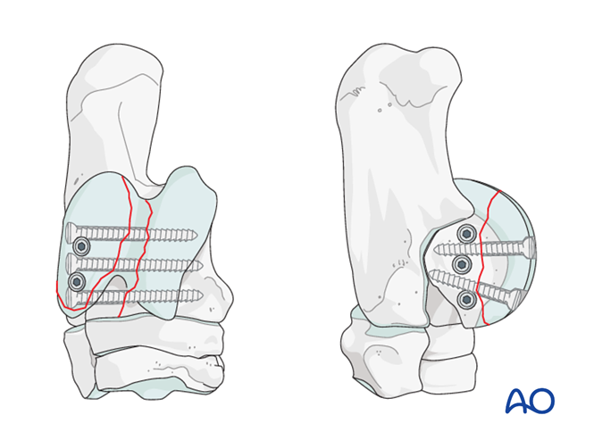 Screw fixation for Talus: Diaphyseal comminuted fractures
