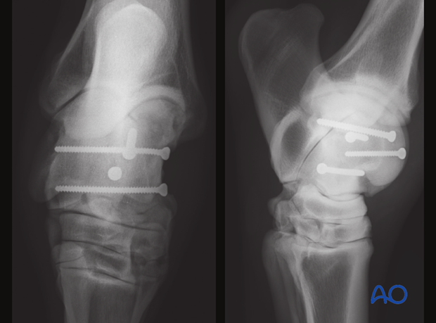 Screw fixation for Talus: Diaphyseal comminuted fractures