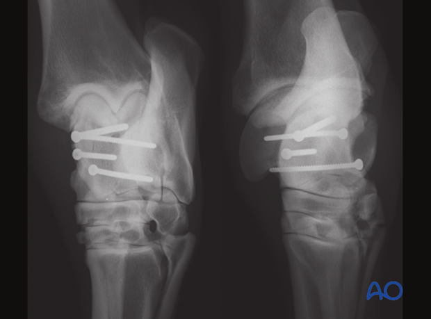 Screw fixation for Talus: Diaphyseal comminuted fractures