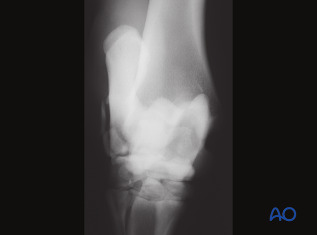 Screw fixation for Talus: Diaphyseal comminuted fractures
