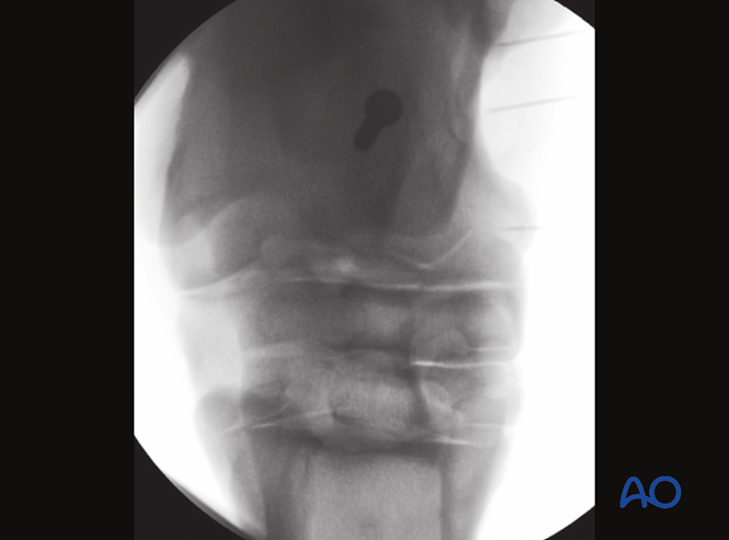 Screw fixation for Talus: Diaphyseal comminuted fractures