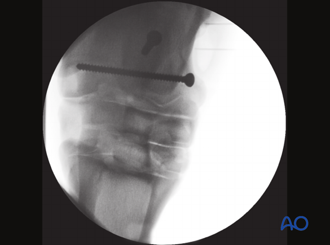 Screw fixation for Talus: Diaphyseal comminuted fractures