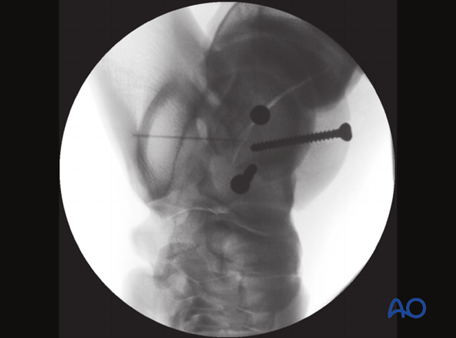 Screw fixation for Talus: Diaphyseal comminuted fractures