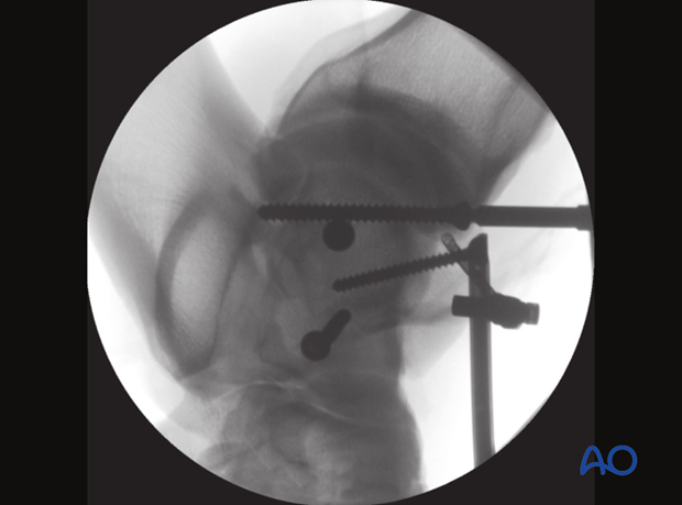 Screw fixation for Talus: Diaphyseal comminuted fractures
