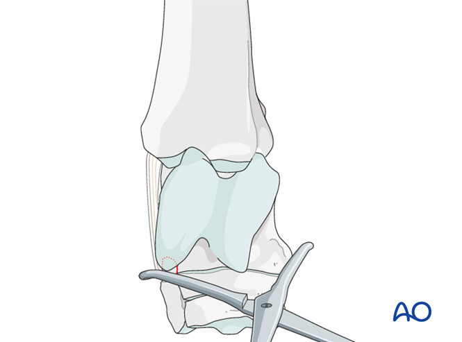 Screw fixation or resection for Calcaneus: Fractures of the collateral ...