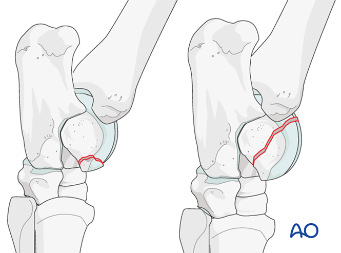 Talus: Trochlear ridge fractures