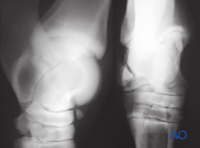Talus: Trochlear ridge fractures