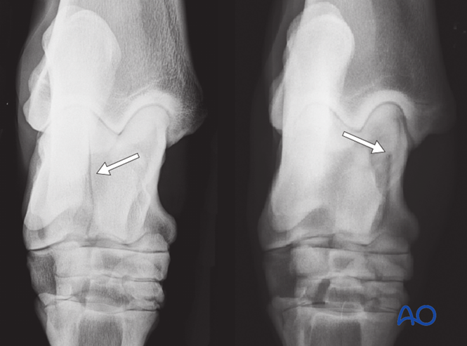 Talus: Trochlear ridge fractures