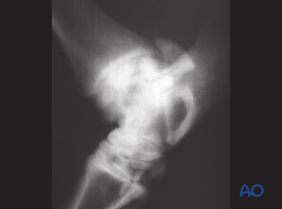 Talus: Trochlear ridge fractures