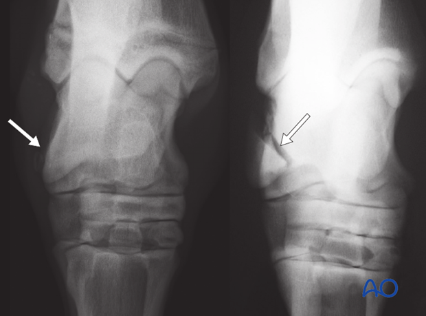 Talus: Trochlear ridge fractures