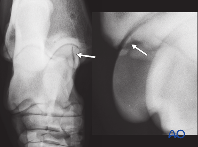 Talus: Trochlear ridge fractures