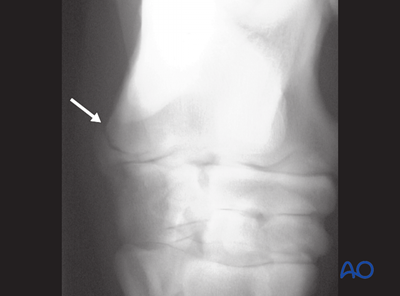 Talus: fractures of the collateral ligament attachment