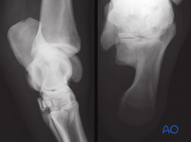 Calcaneus: Sustentaculum tali fractures