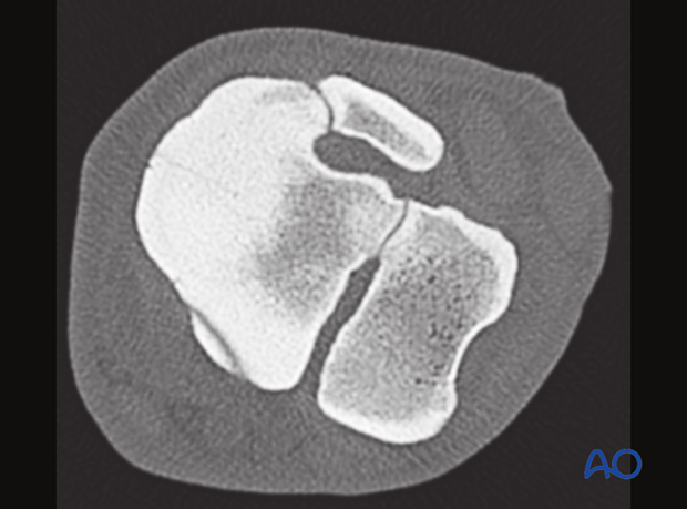 Tarsal bones: Central comminuted fractures