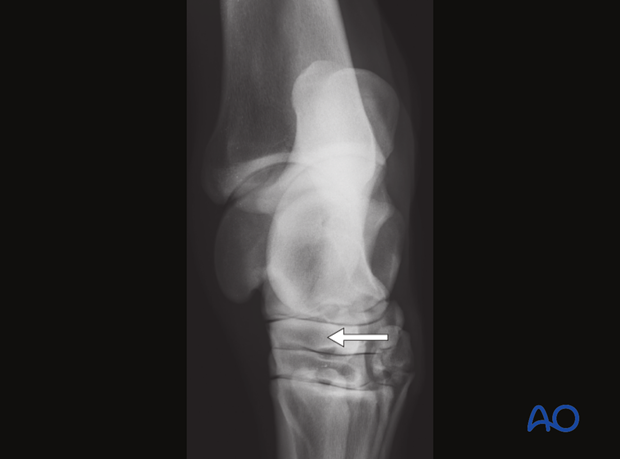 Tarsal bones: Central comminuted fractures