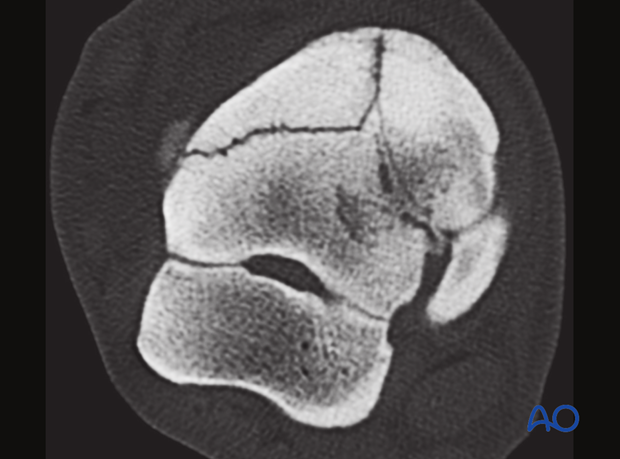 Tarsal bones: Central comminuted fractures