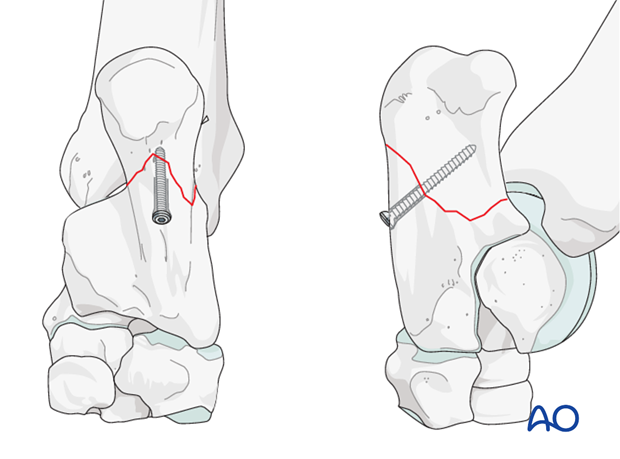 Plate fixation for Calcaneus: Simple diaphyseal fractures