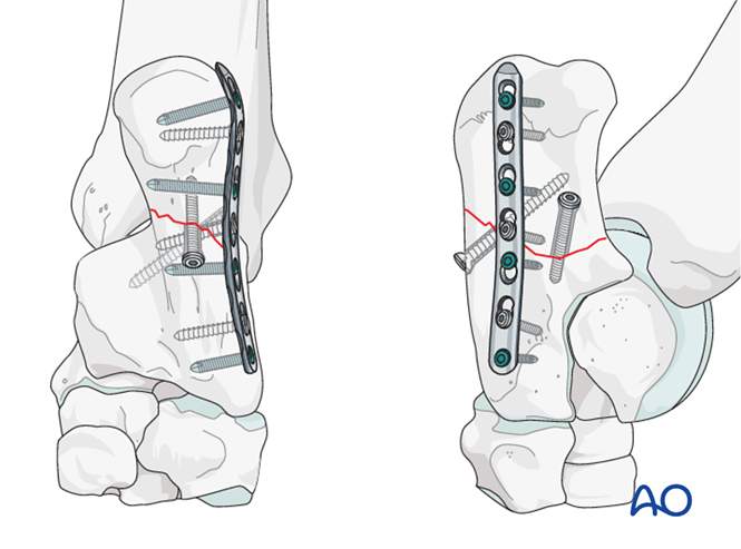 Plate fixation for Calcaneus: Simple diaphyseal fractures