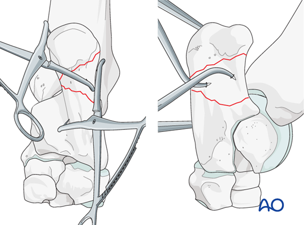 Plate fixation for Calcaneus: Comminuted diaphyseal fractures