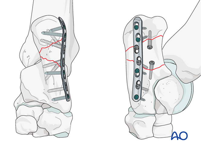 Plate fixation for Calcaneus: Comminuted diaphyseal fractures